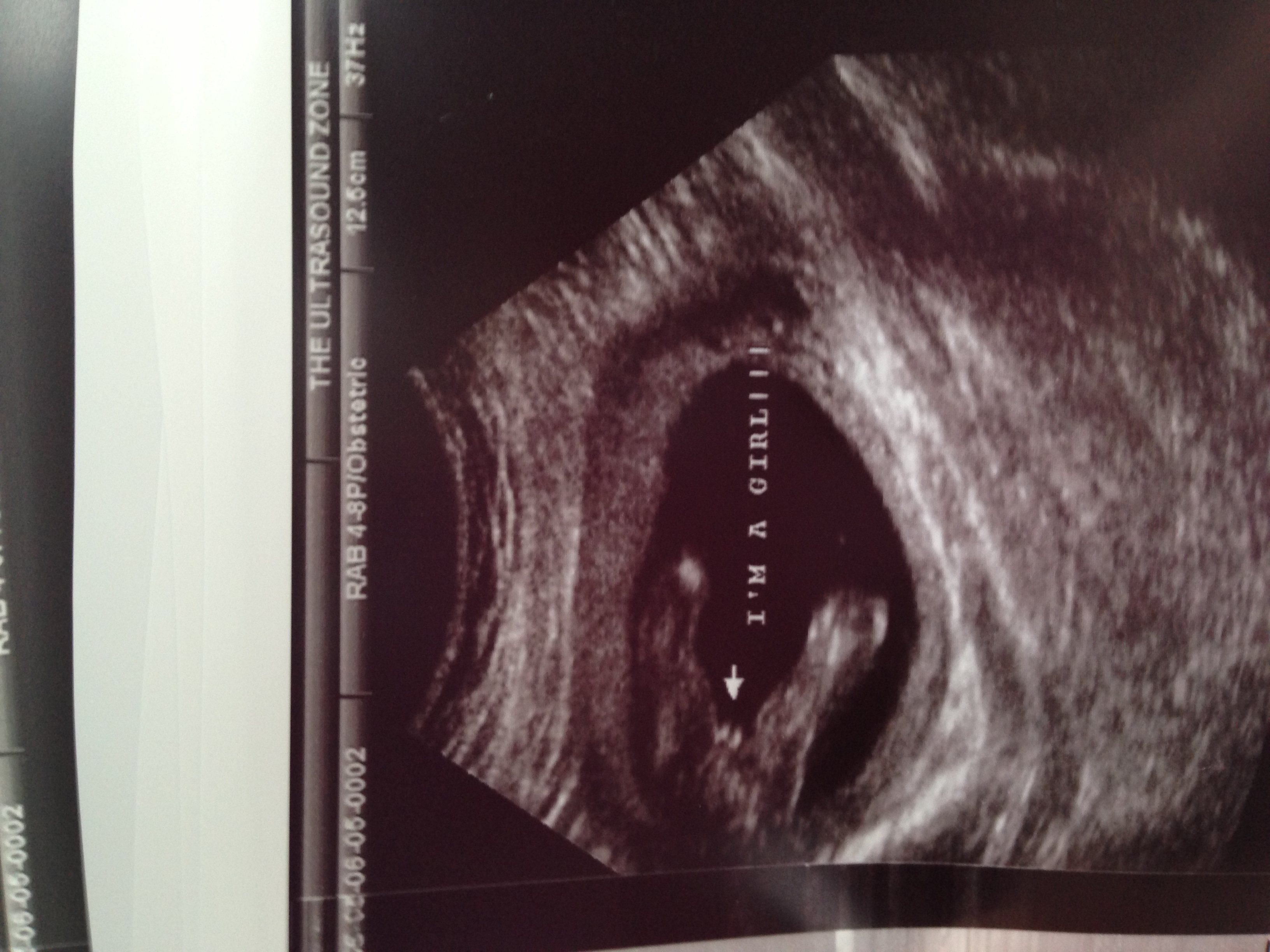 15 week scan says a girl! Where is the third line?
