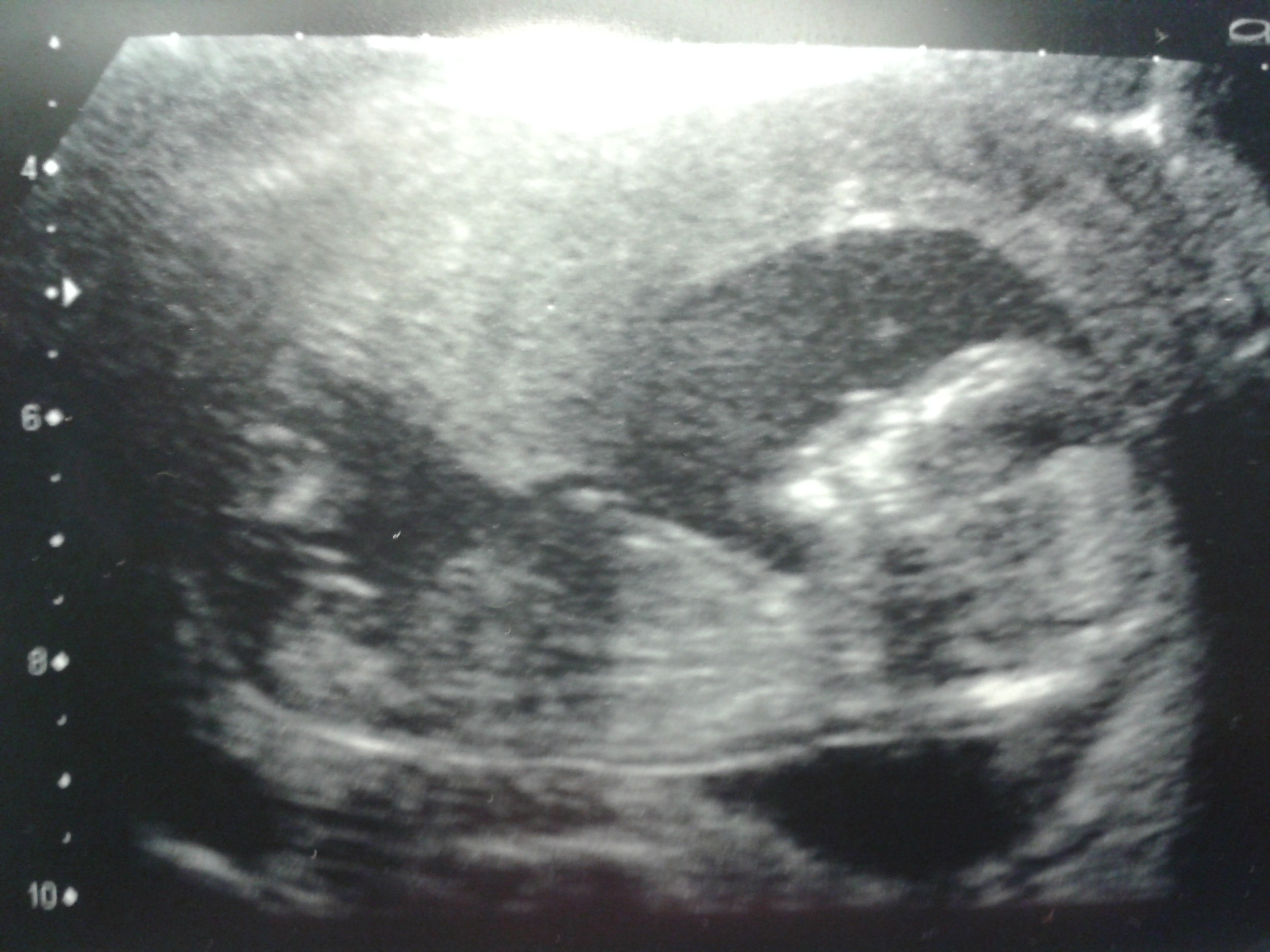 13w 4d ultrasound nub theory/gender prediction please :)