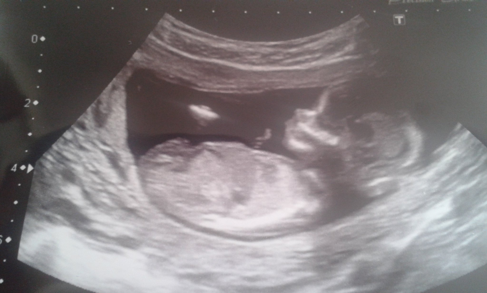 very clear scan, 14 weeks is it a boy or girl!