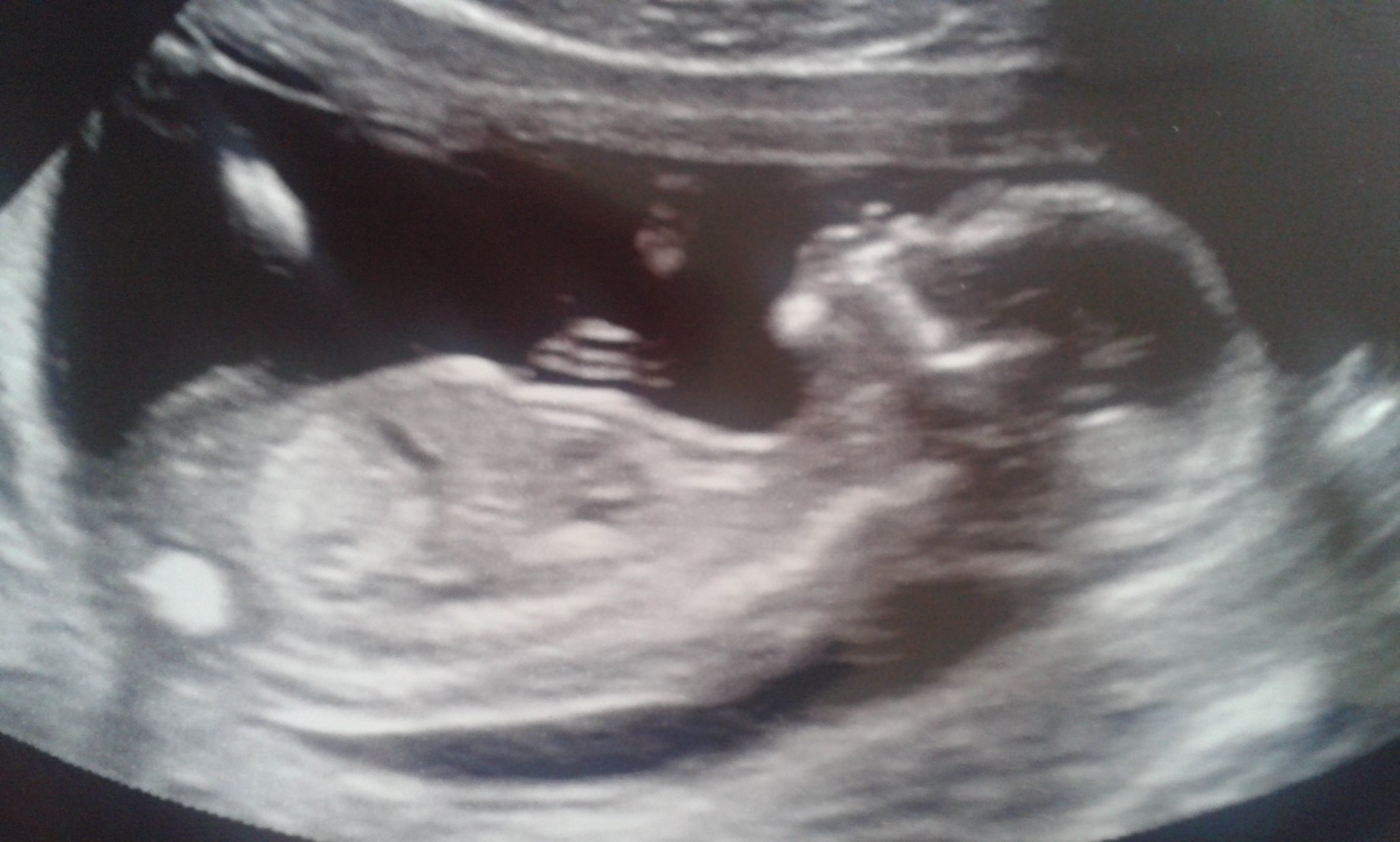 very clear scan, 14 weeks is it a boy or girl!