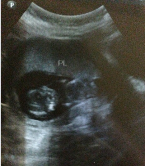 12+3 weeks scan: Any guess by nub and skull theory?