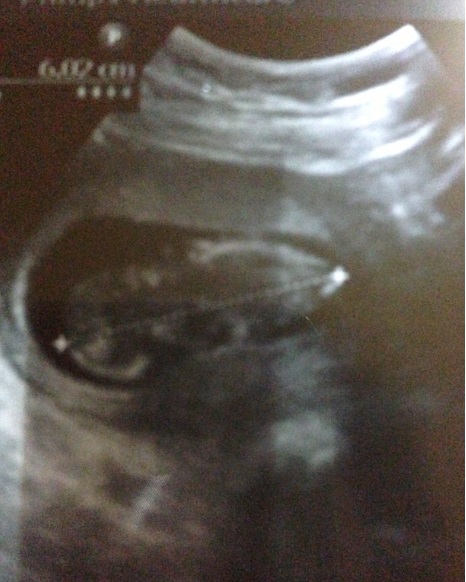 12+3 weeks scan: Any guess by nub and skull theory?