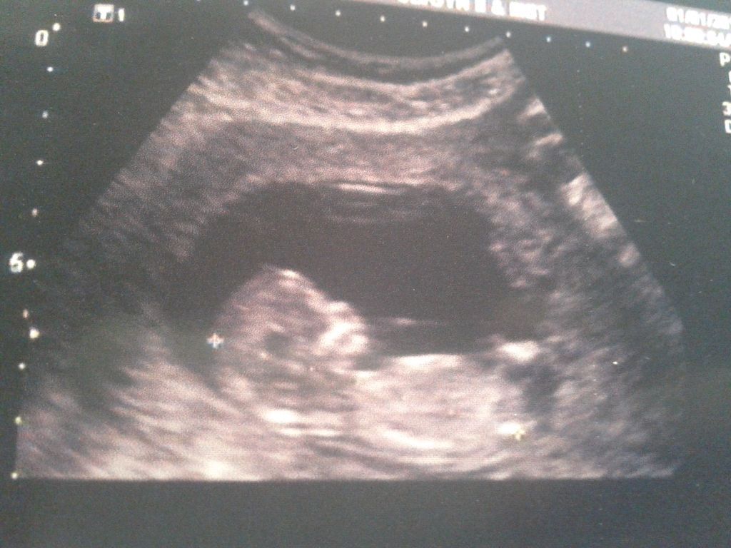 13w1d Boy or Girl preditcions please!!!