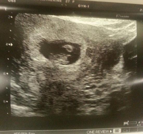ramzi guess please abdominal and vaginal 7 week scan