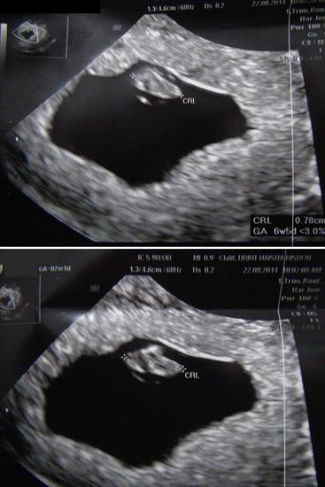 RAMZI method, What is the gender, boy or girl?