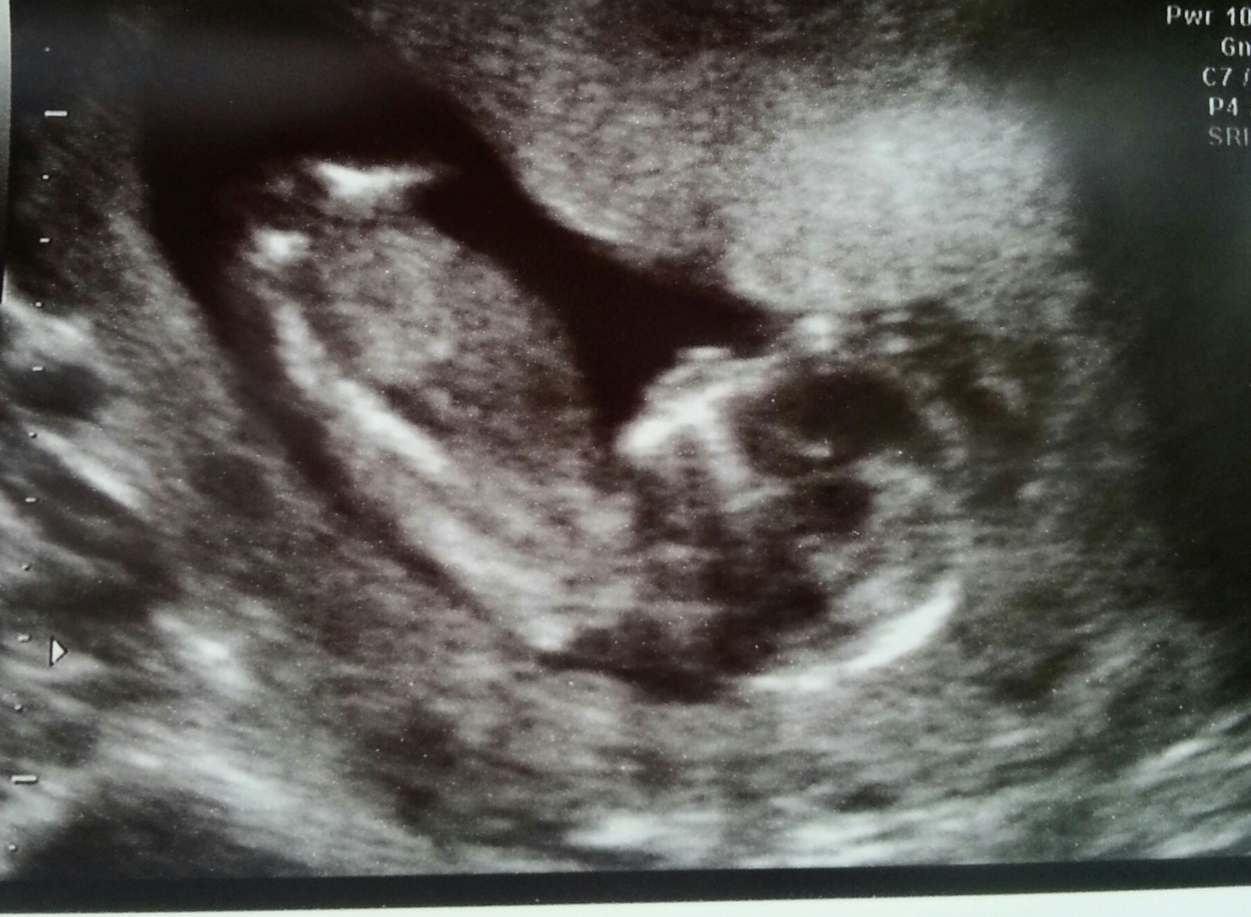 13 week scan. Gender prediction plz??