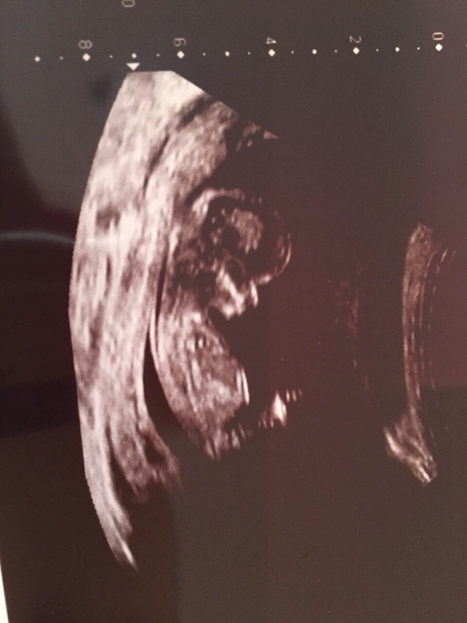 13 week scan, boy or girl?