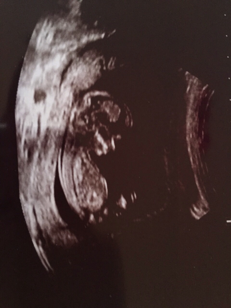 13 week scan, boy or girl?