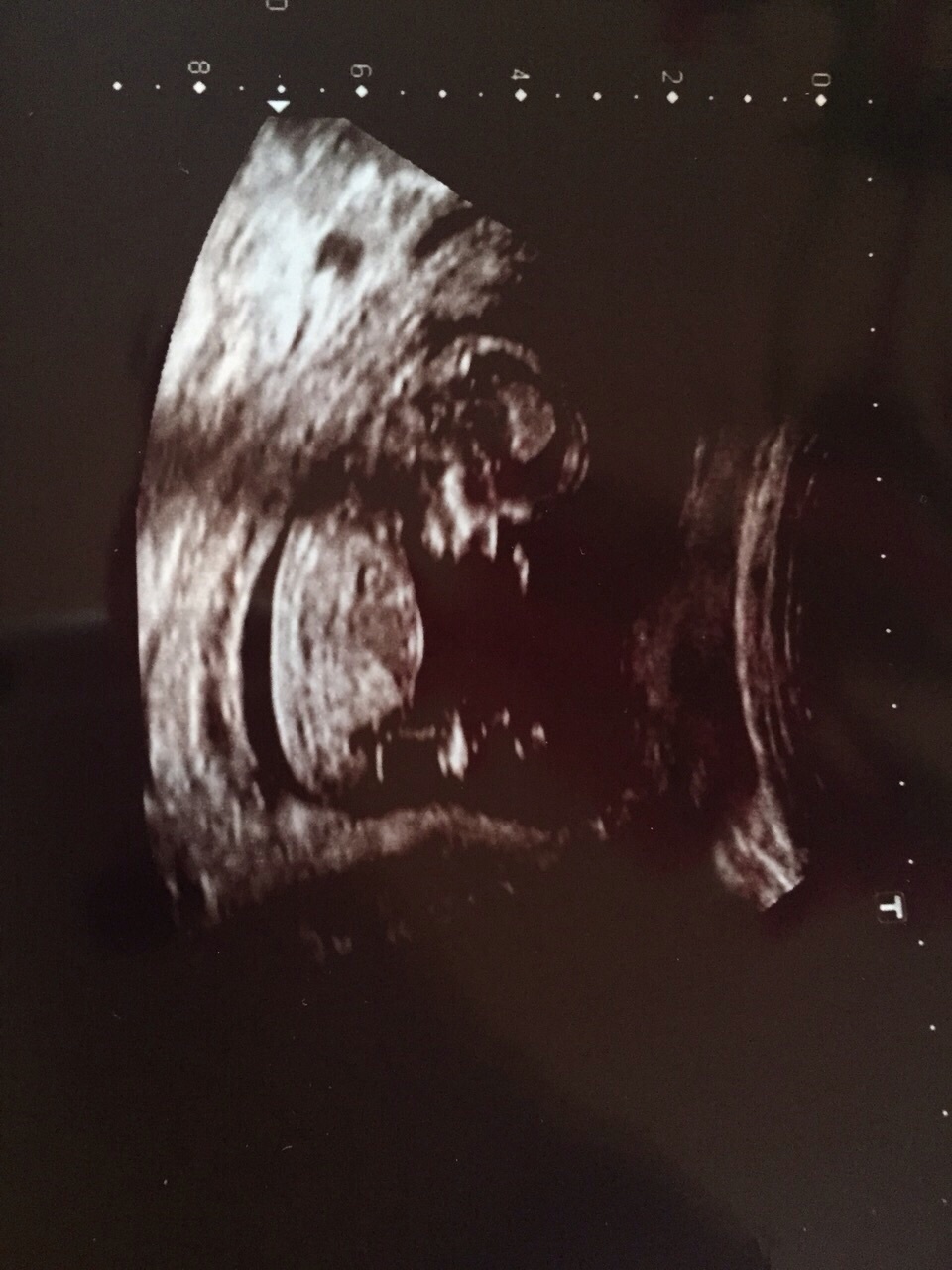 13 week scan, boy or girl?