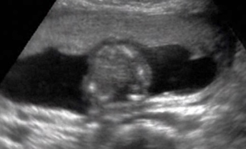 16w6d potty shots from 3d scan - Page 3