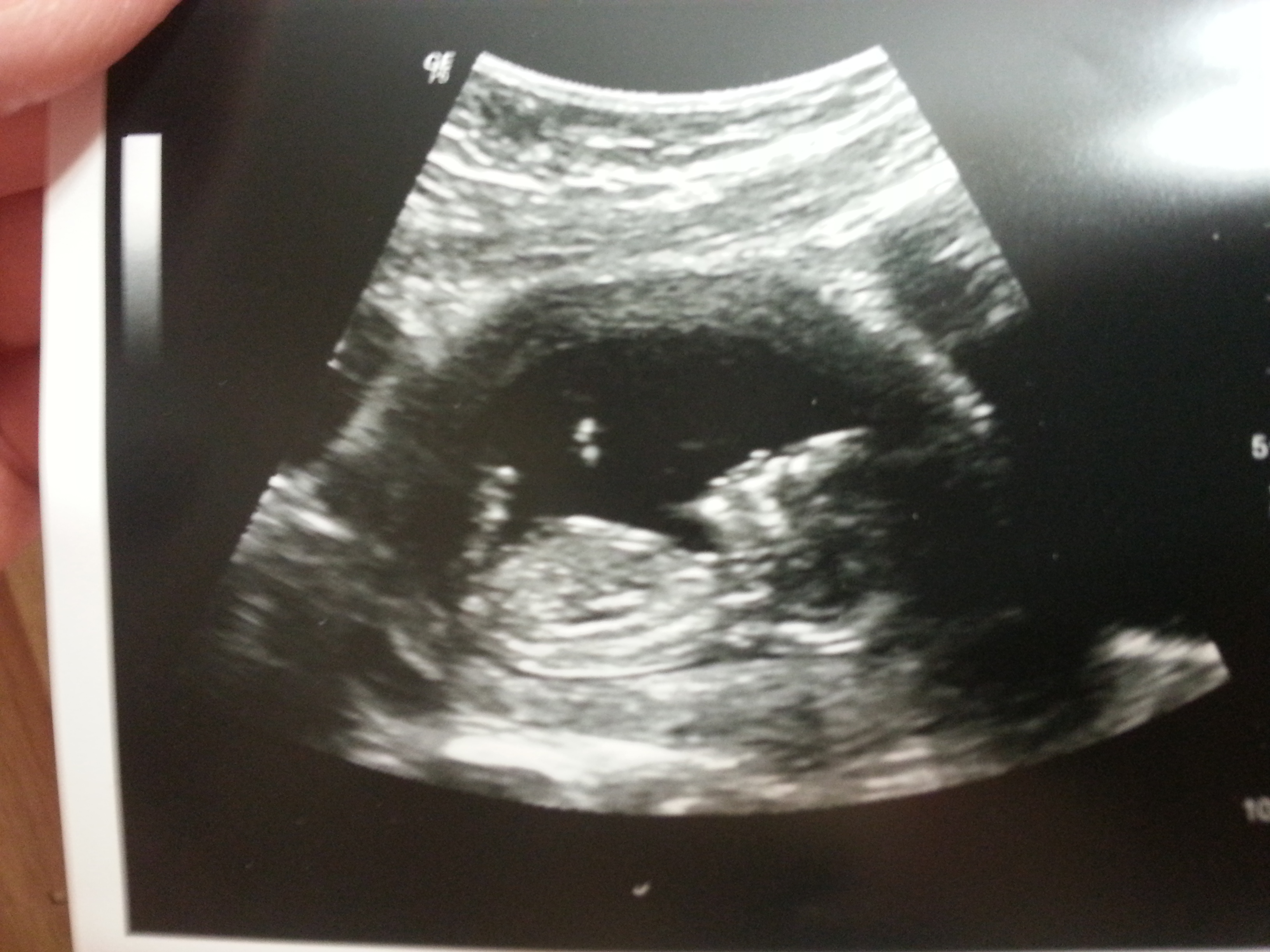 13 week gender prediction