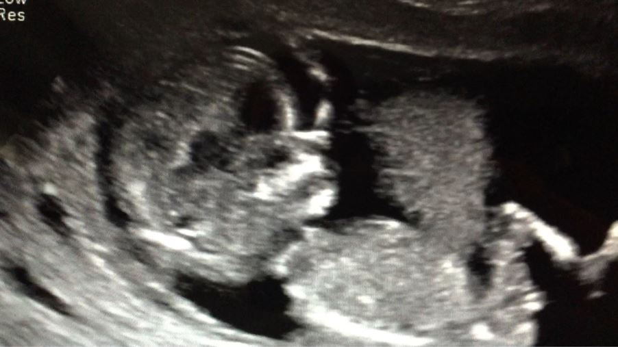 Boy or Girl? NT Scan Pictures from 13 weeks