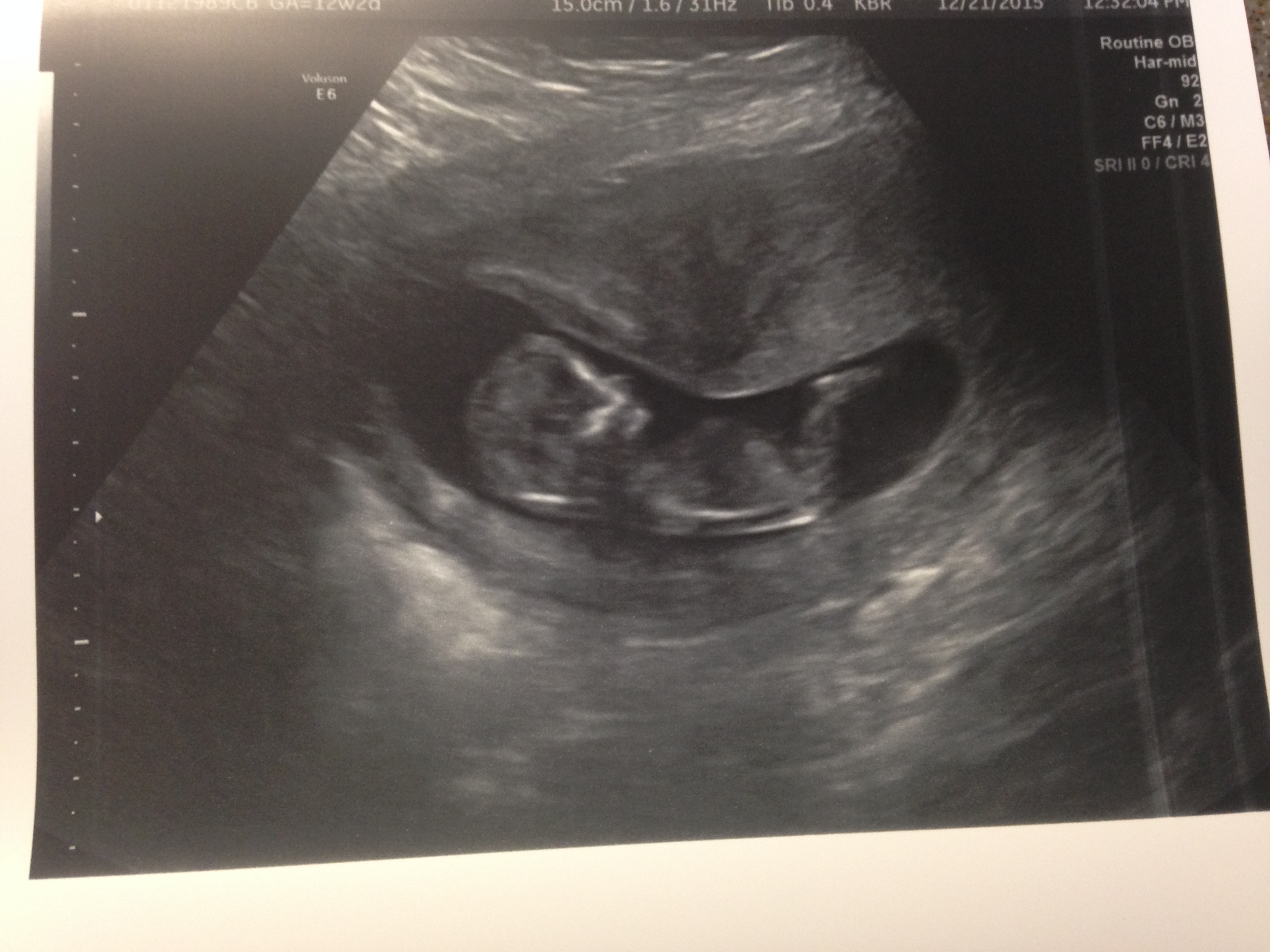NT scan baby measuring 13 weeks