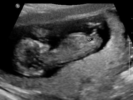 Girl or Boy Please :) 12 weeks scan