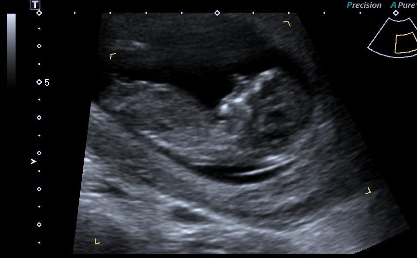 12 Week Scan.. Boy or Girl??