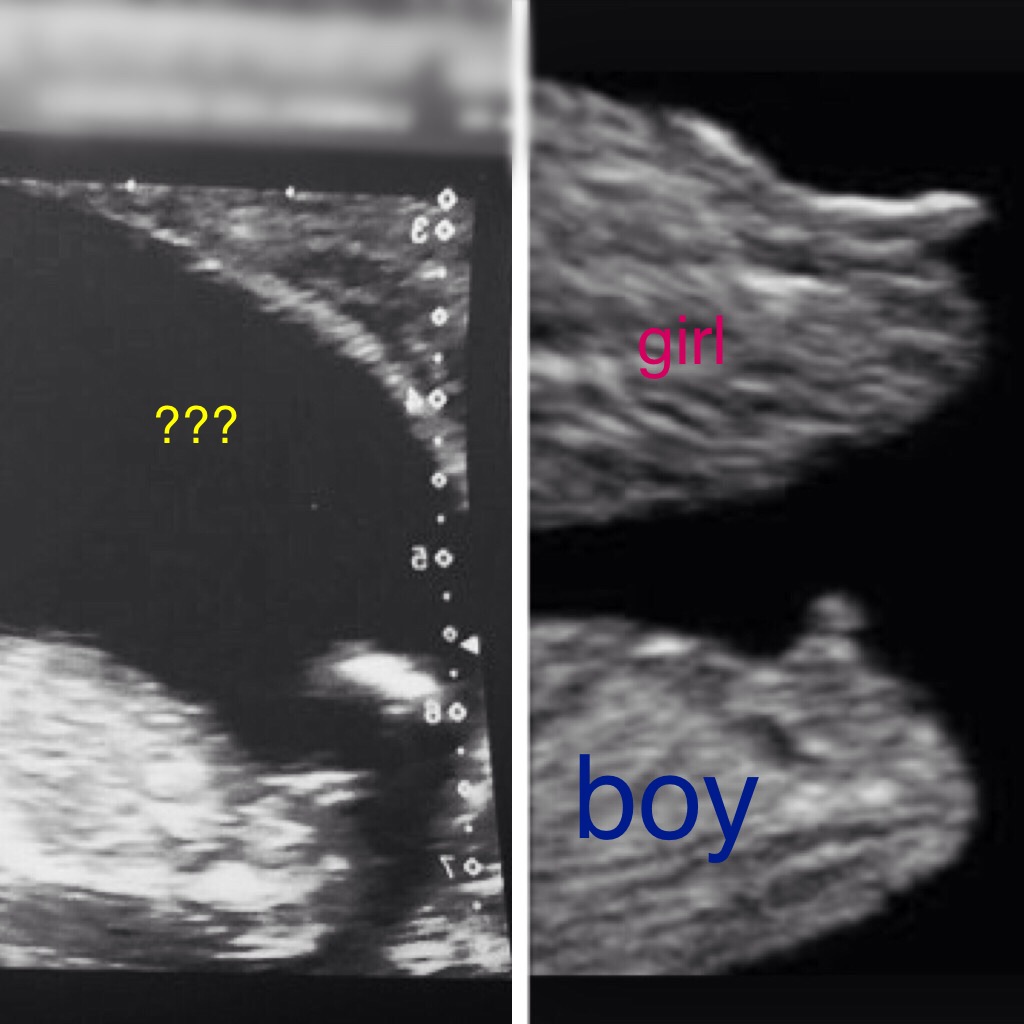 Before your NT scan!! Learn what to look for, a lesson in boy and girl ...