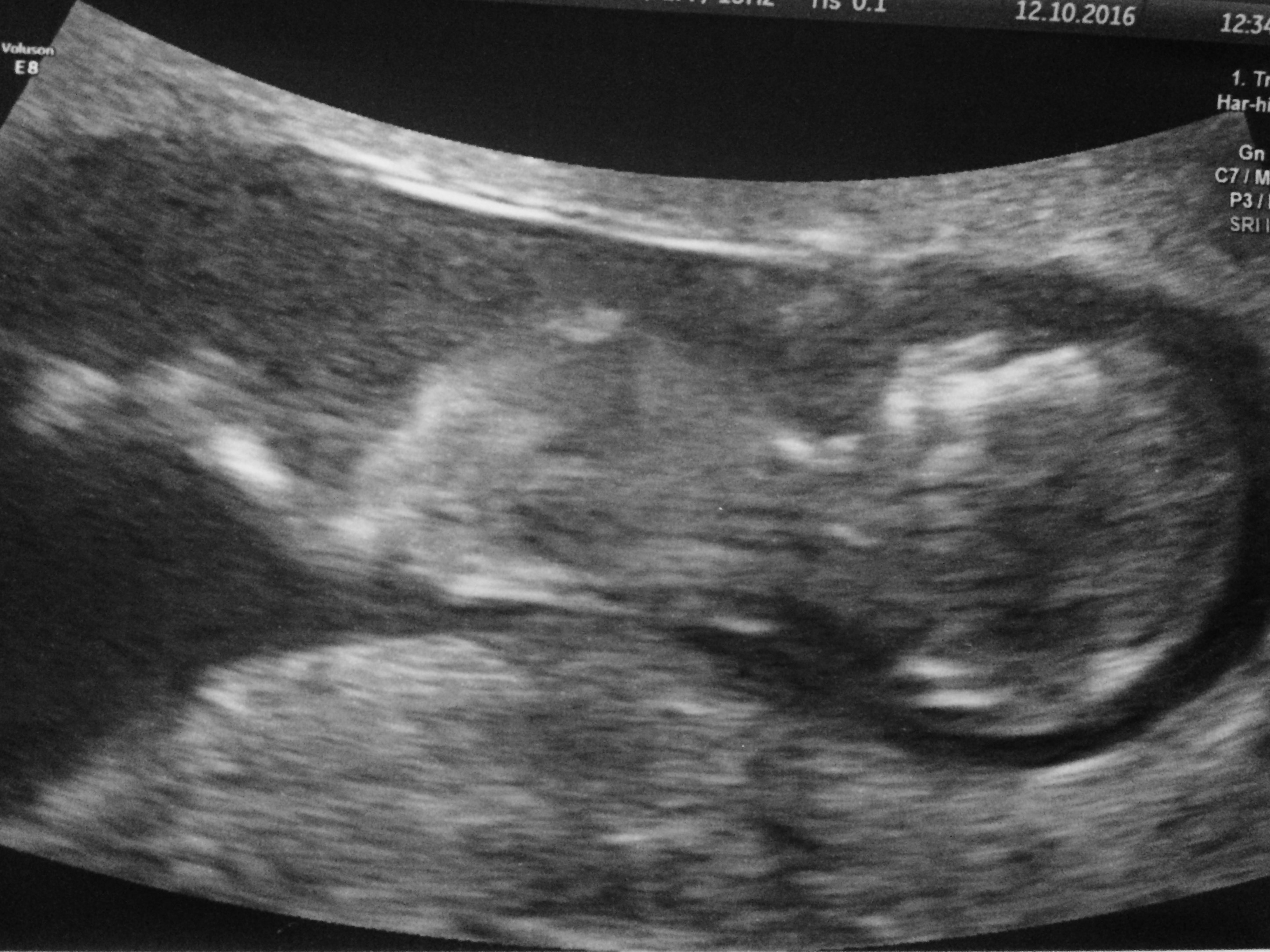 12+4week scan pics... boy or girl???