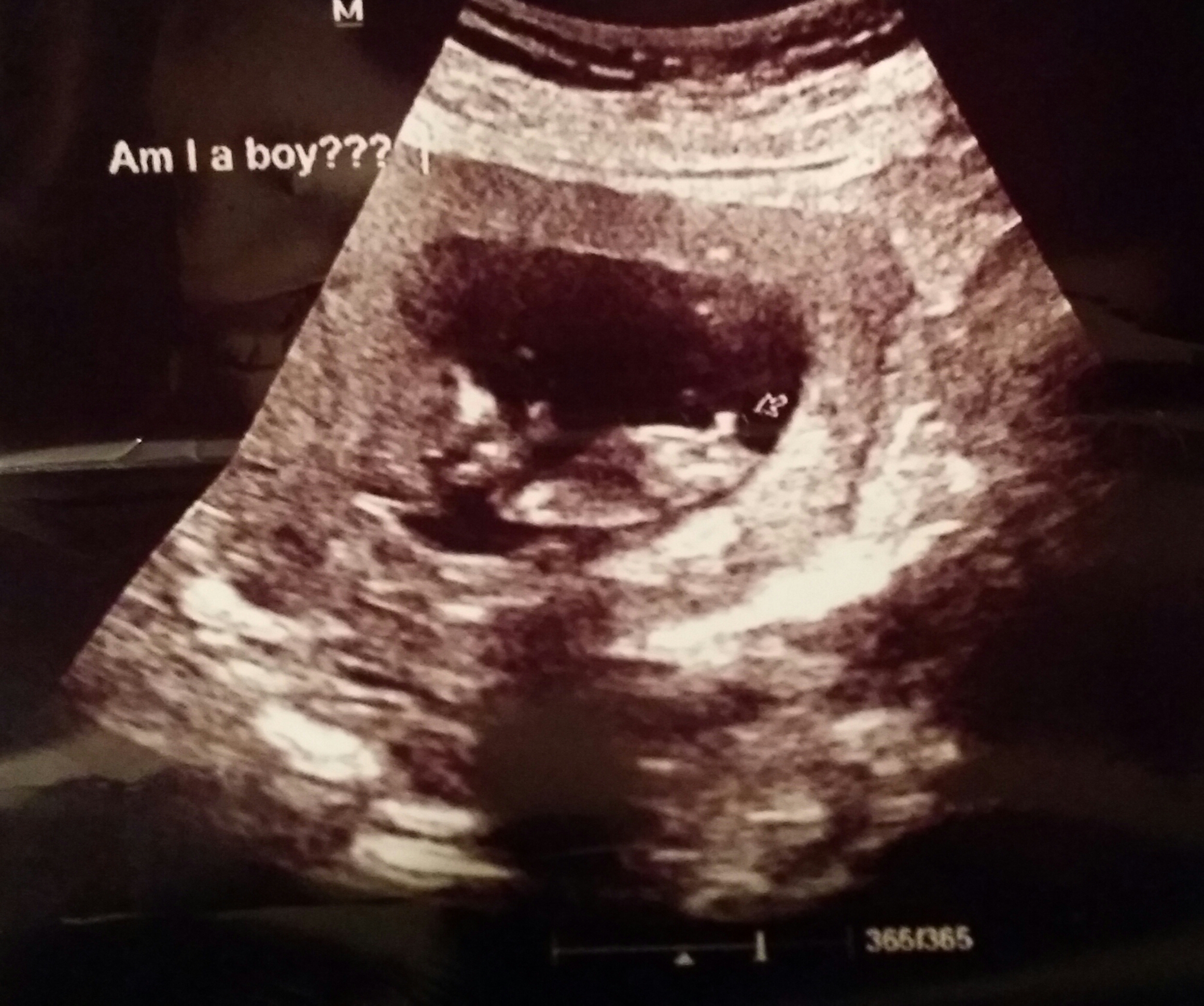 Nub Theory 11w5d BOY OR GIRL?