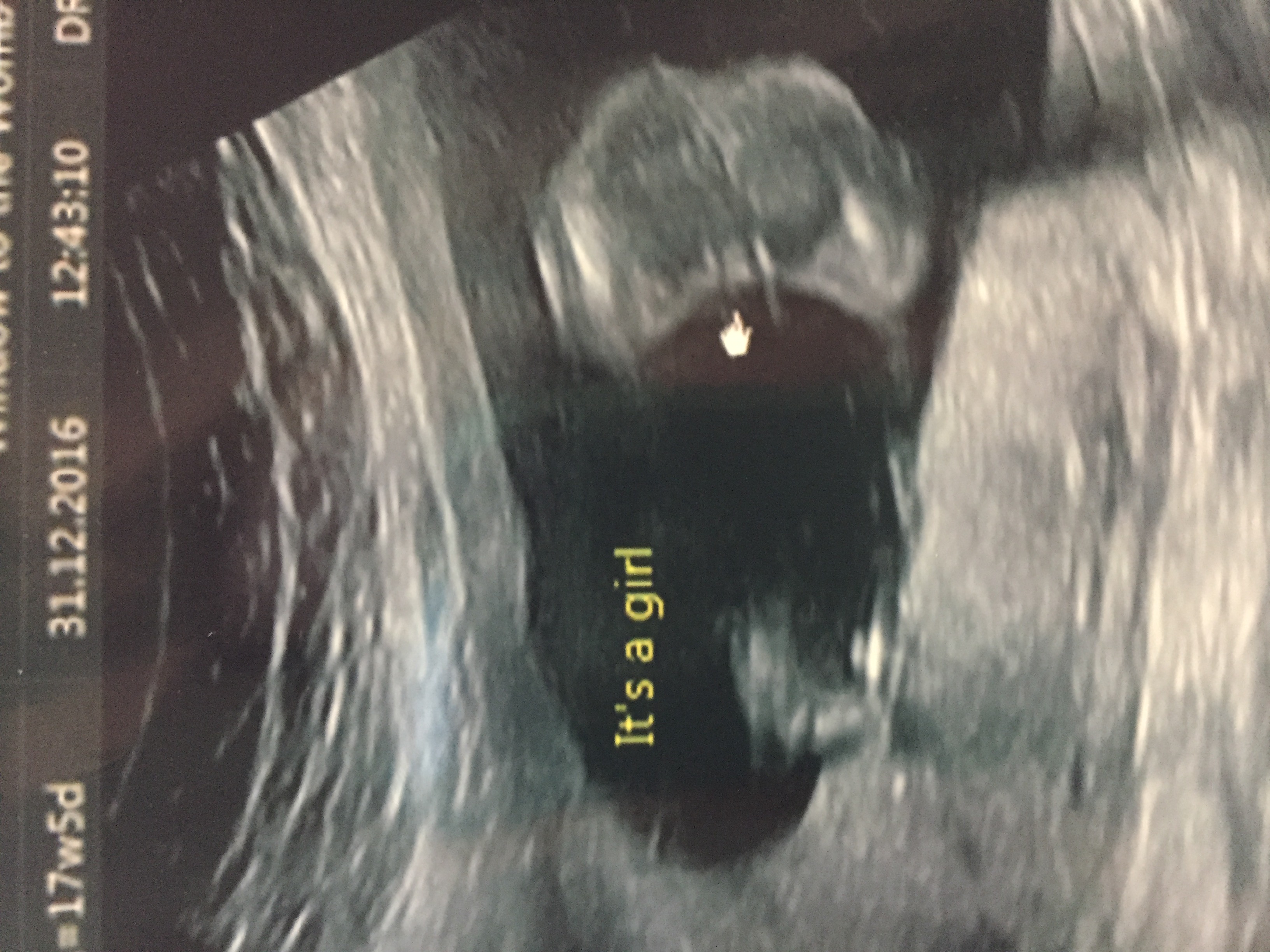 17 week 5 days gender scan