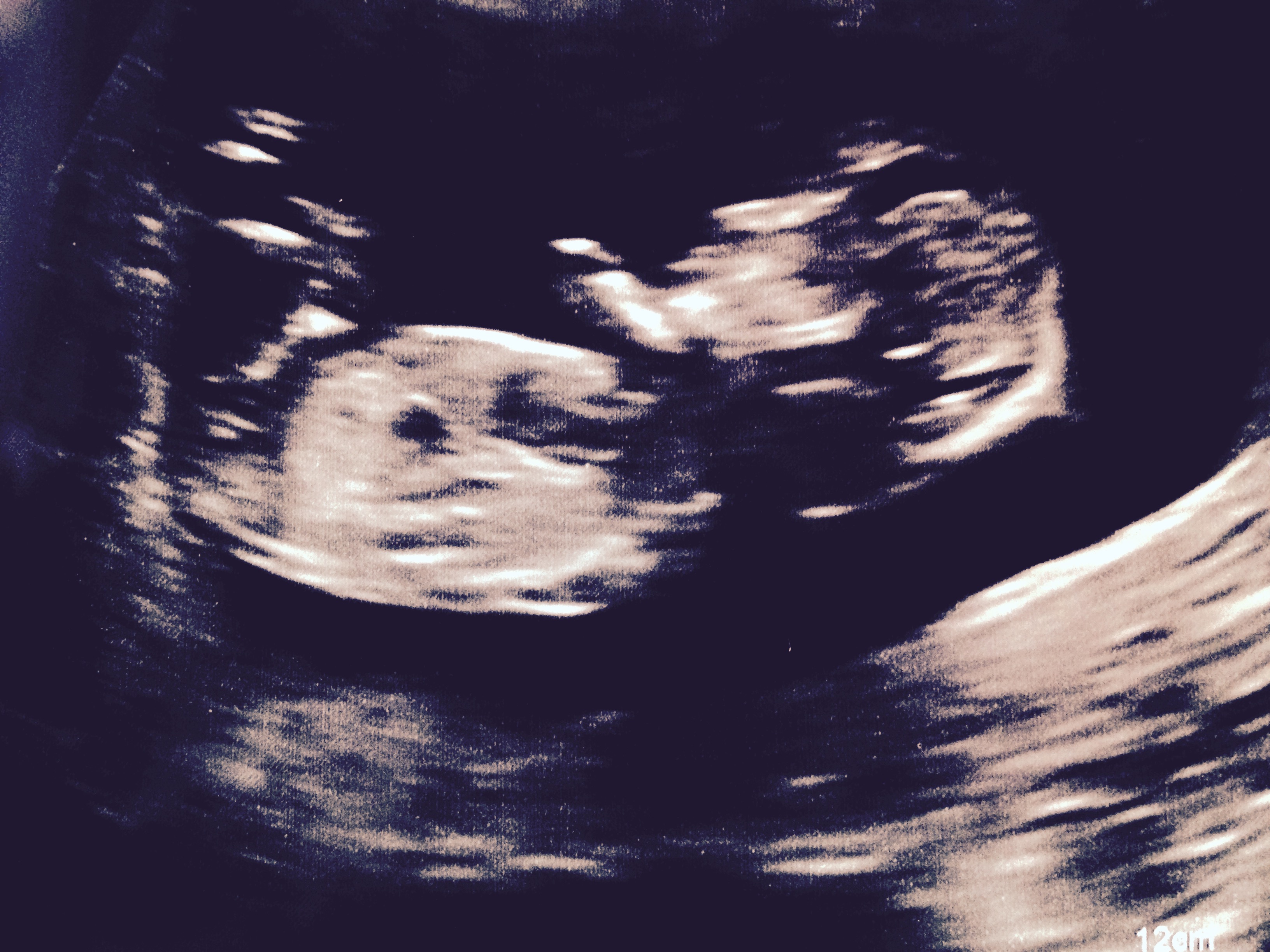 13 and 17 week scans- and gender clues?