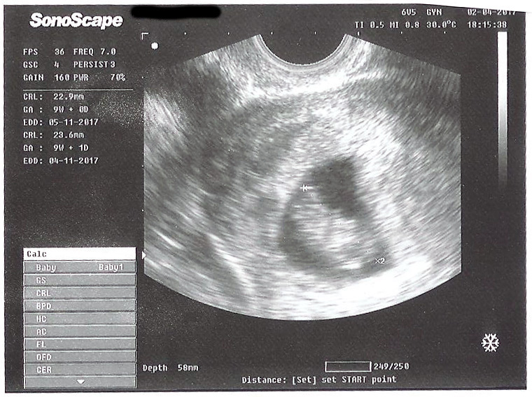 11w5d and 9w1d U/S shots - guess the gender