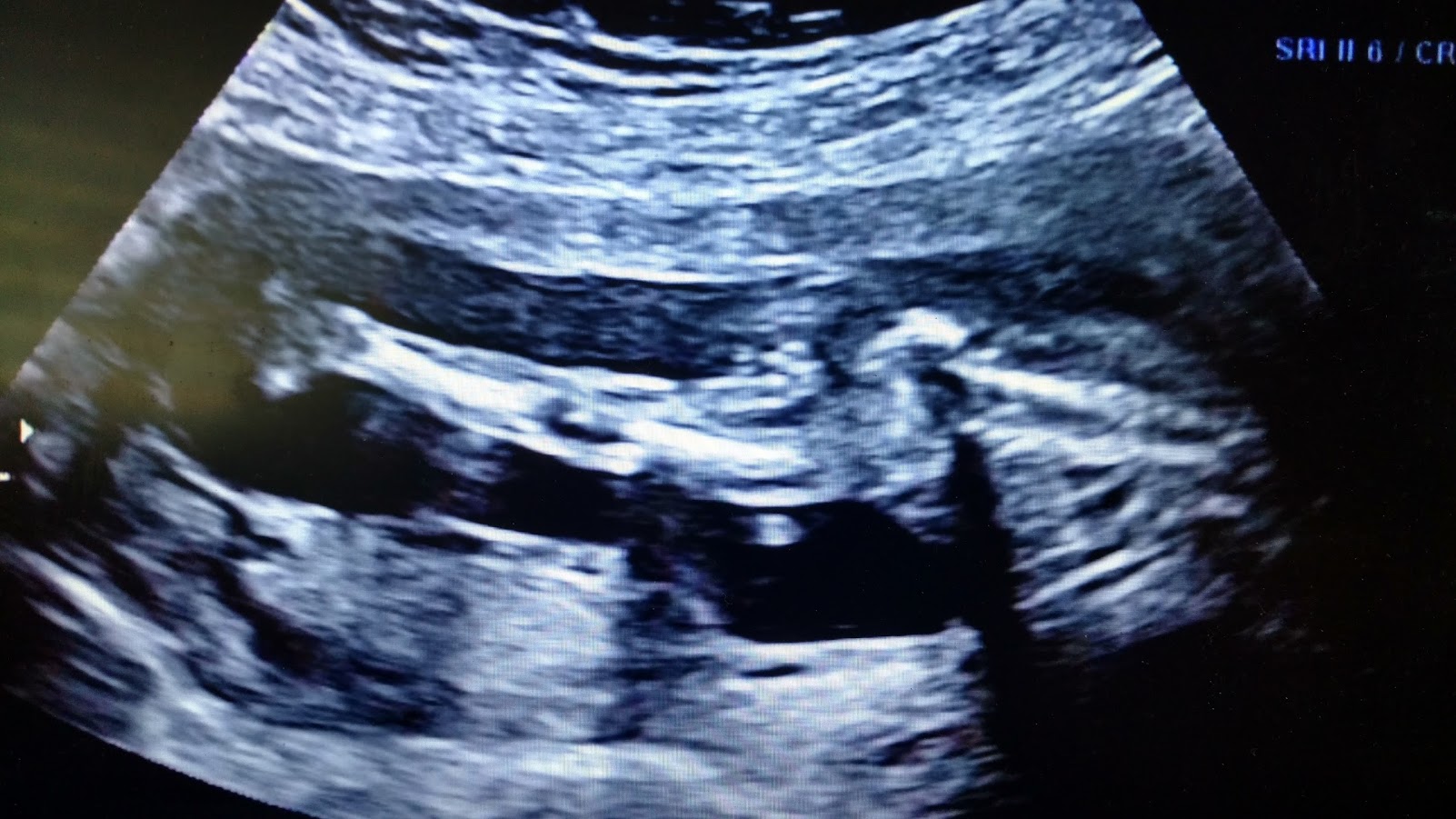 Boy or Girl?!?! 14w5d potty shot