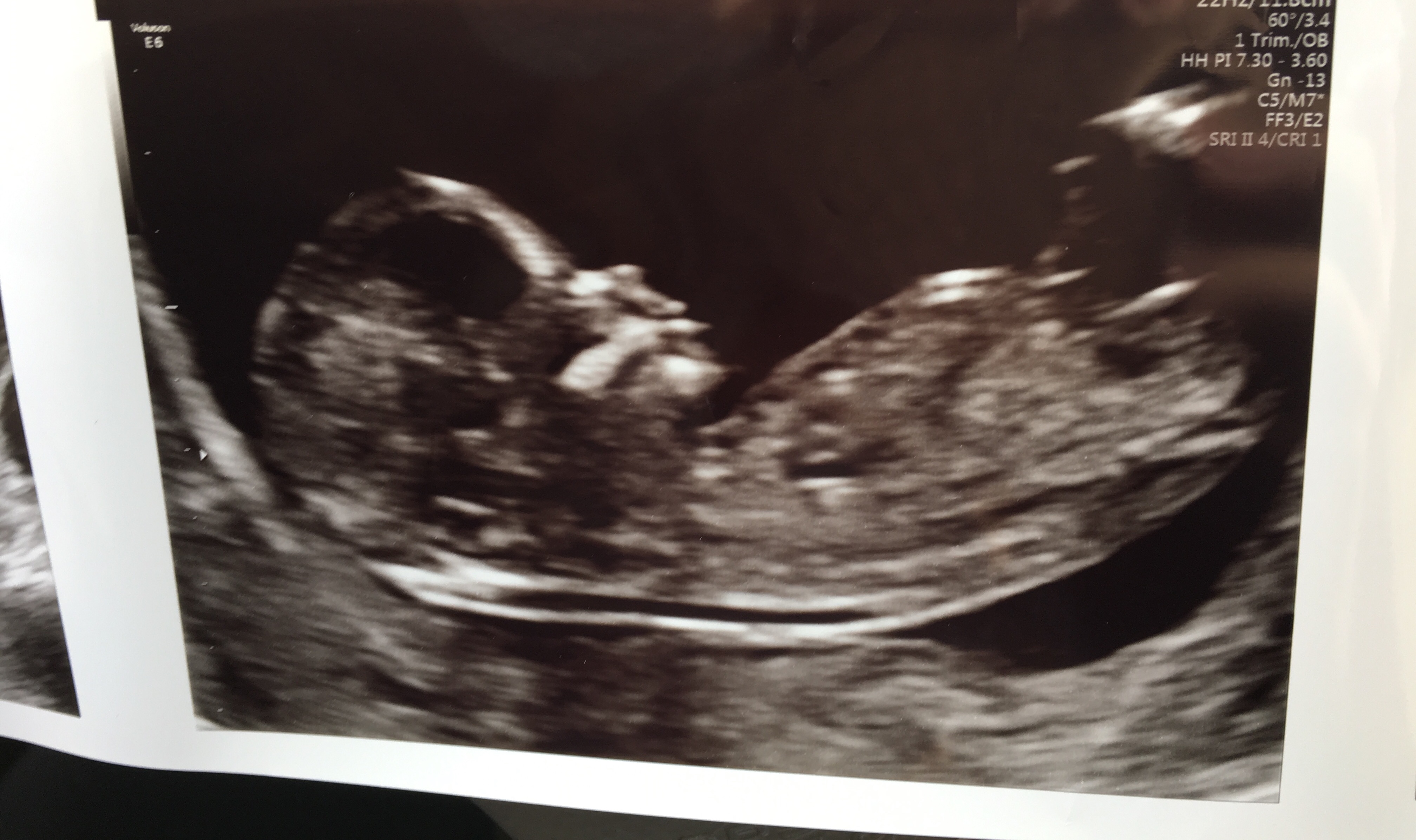 12w 6d Nub - Boy or Girl?