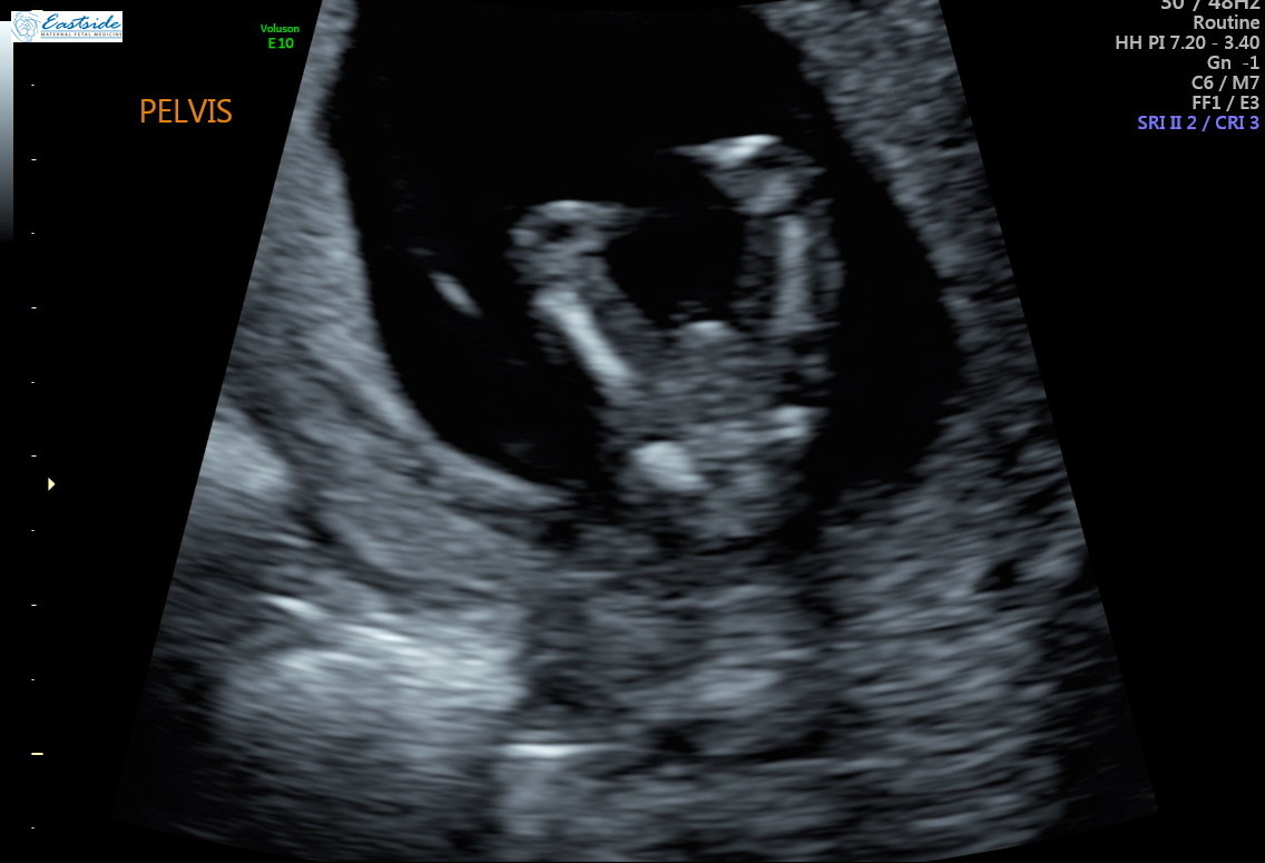 13 week 4d ultrasound pictures - feticm