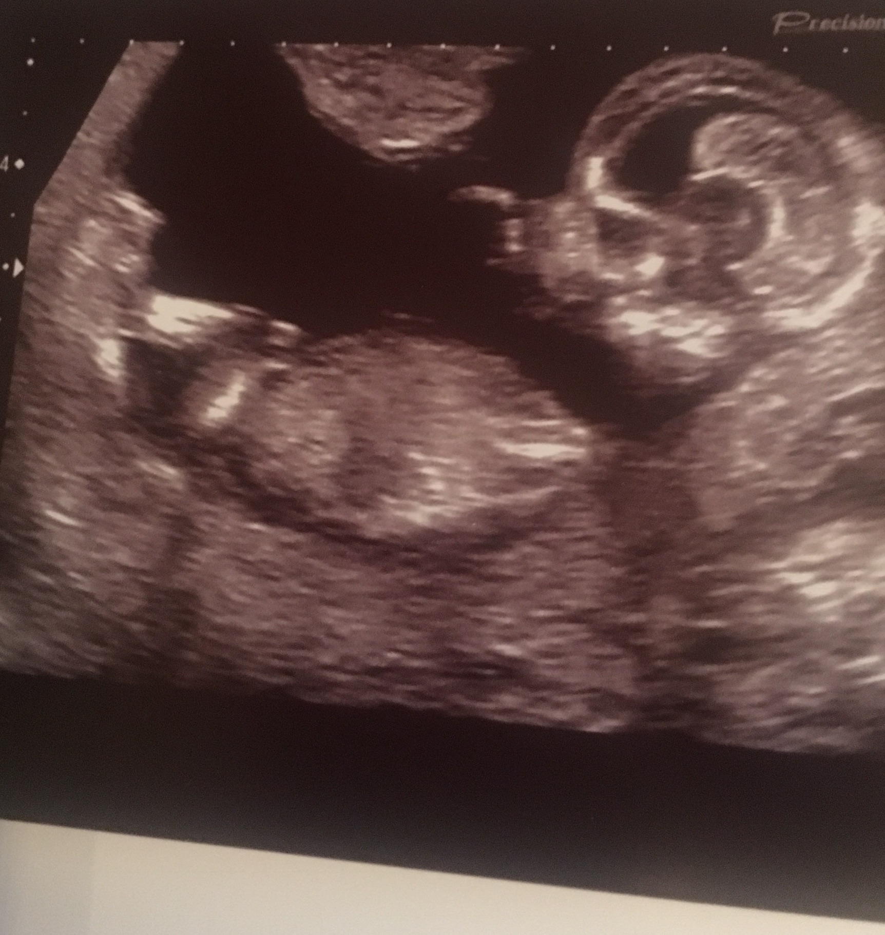 13w 1d ultrasound