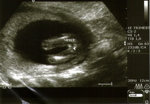 16 Weeks Gender Scan