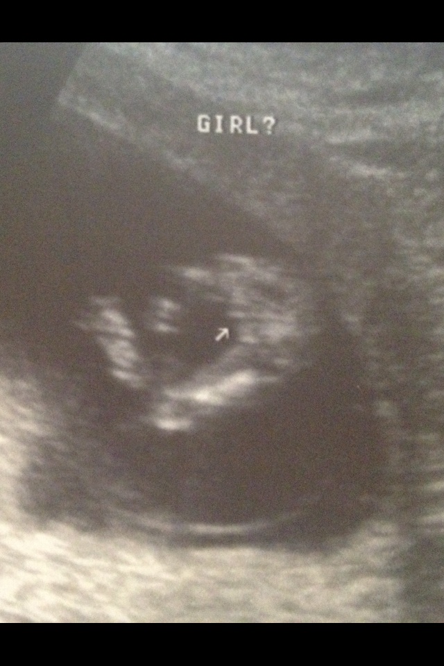 15 week ultrasound and it's a......
