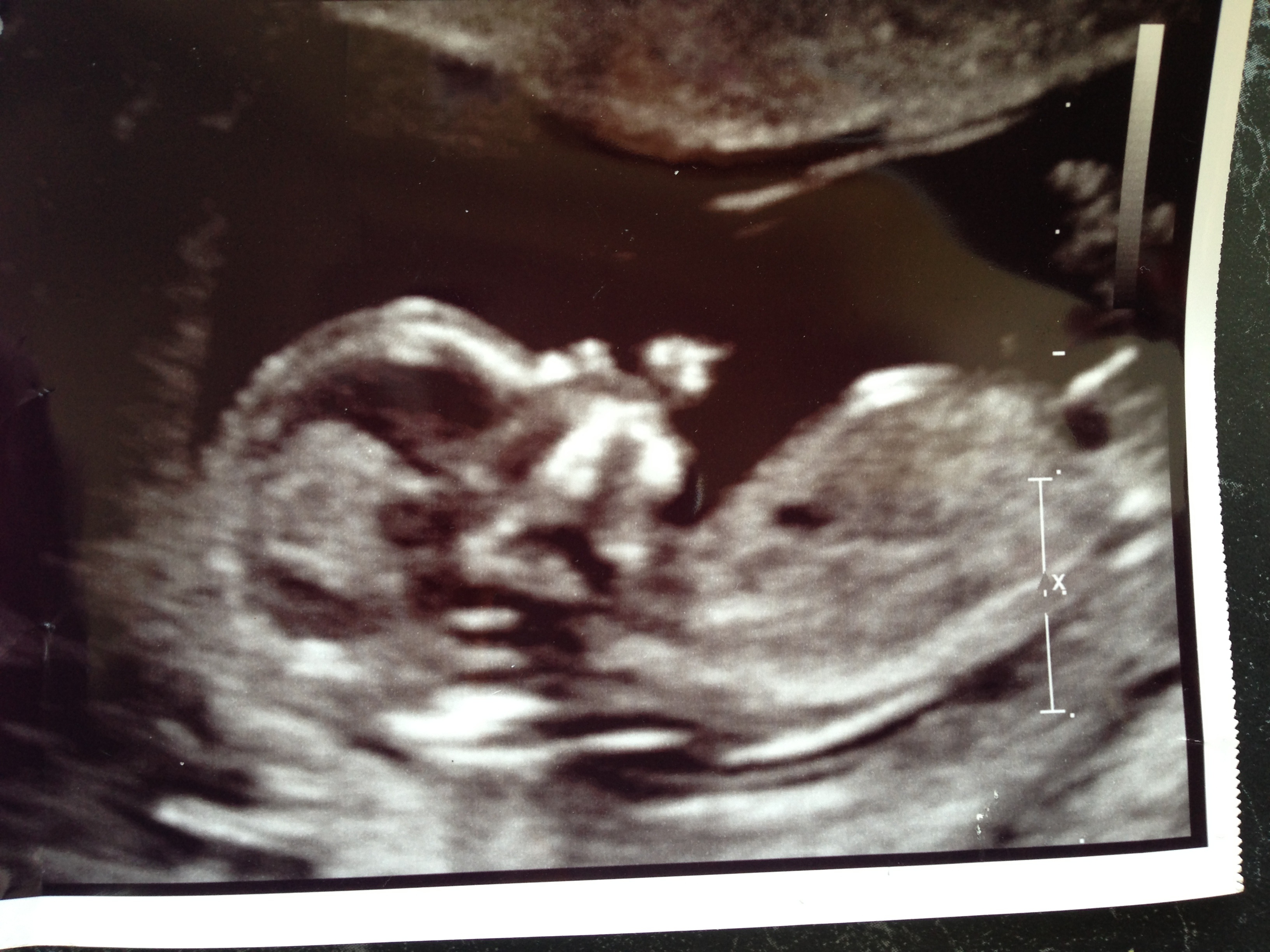 14 week scan boy or girl please